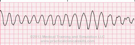 Monomorphic And Polymorphic Ventricular Tachycardia Ventricular