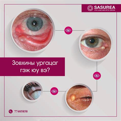 Сасуриа нүдний эмнэлэг Sasurea Eye Clinic ЗОВХИНЫ УРГАЦАГ ГЭЖ ЮУ ВЭ 👩‍⚕️ Зовхины ургацаг нь