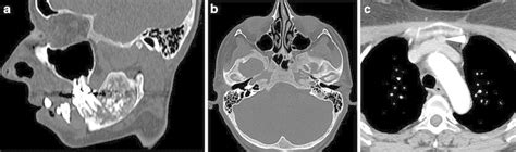 Sagittal Oblique Ct And B Axial Ct Image Of The Skull Base C Axial Ct Download Scientific