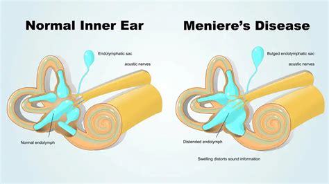 Why Menieres Disease Can Cause Bppv The Vertigo Doctor