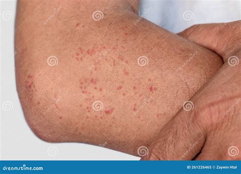 Multiple Itchy Mosquito Or Insect Bite Wheals Red Spots On The Forearm