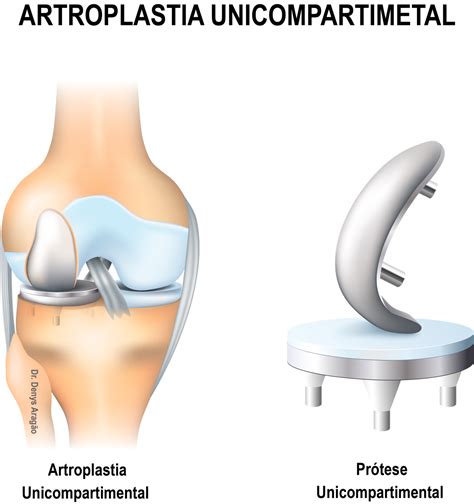 Prótese Unicompartimental Dr Denys Aragão