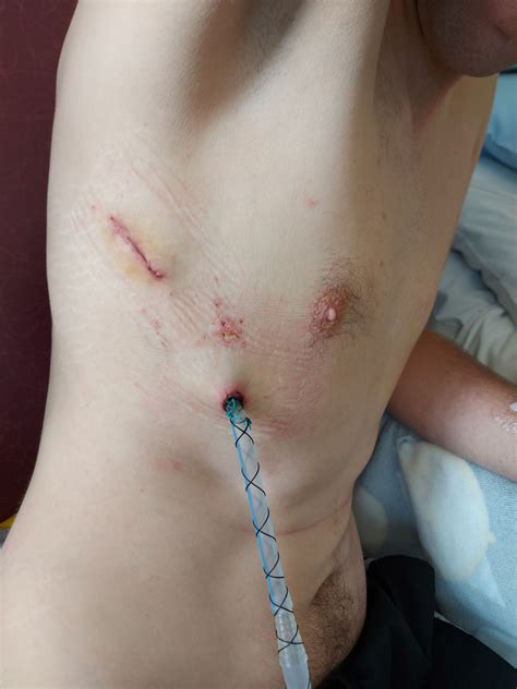 Lung Surgery For Collapsed Lung