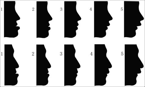 Differences In Facial Profile And Dental Esthetic Perceptions Between