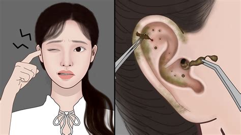 Relax 10 Min Asmr Blackhead And Pimple Popping Animation Mengs Stop