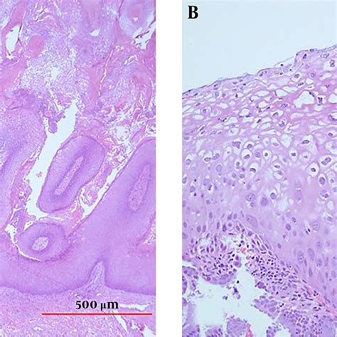 Opened Radical Circumcision Specimen Showing Tumour On Inner Mucosal Download Scientific