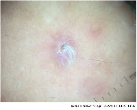 Translated Article Vellus Hair Cyst Of Several Months Duration On