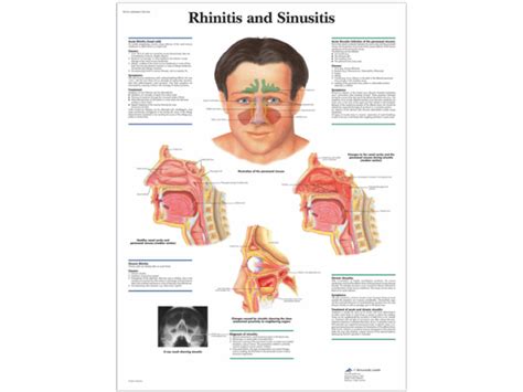 Anatomical Chart Rhinitis And Sinusitis A 1 Medical Integration