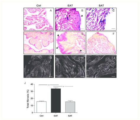 Epicardial Adipose Tissue Induces Atrial Fibrosis Massons Trichrome