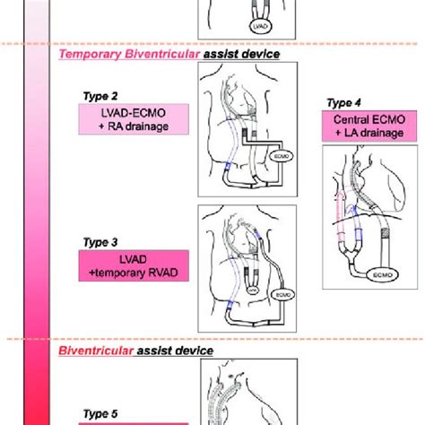 Types And Selection Of Central Ventricular Assist Device Download