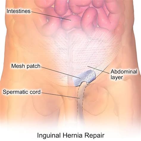 Mesh Repair For Hernia Recovery For Body Health Dr Stephen Watson