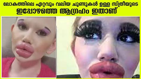 ലോകത്തിലെ ഏറ്റവും വലിയ ചുണ്ടുകള്‍ ഉള്ള സ്ത്രീയുടെ ഇപ്പോഴത്തെ ആഗ്രഹം