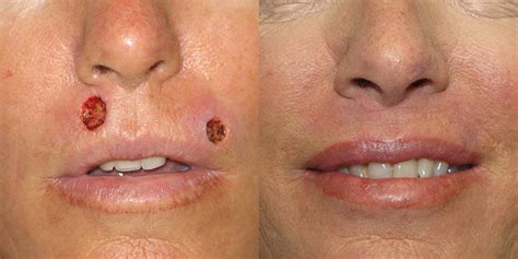 Lip Reconstruction After Skin Cancer Excision Skin Cancer And