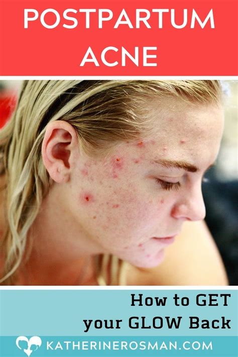 Rosacea Erkennen Und Vorbeugen Artofit