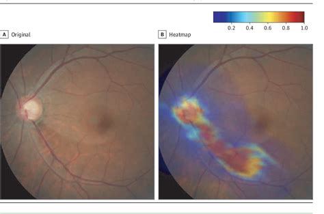 Table 1 From Development And Validation Of A Deep Learning System To Detect Glaucomatous Optic