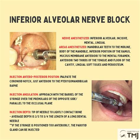 Inferior Alveolar Nerve Block Inferior Alveolar Nerve Block Local