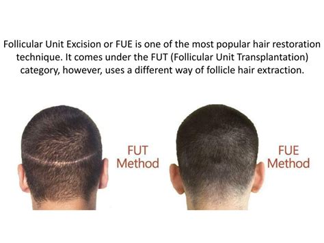 Ppt Advantages And Disadvantages Of Follicular Unit Excision