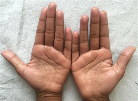 Sweaty Palms And Hands Causes Cures Surgery Remedies During Pregnancy And More American Celiac