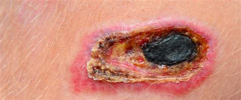Managing Your Wound What Does Necrotic Tissue Look Like And Why It Matters