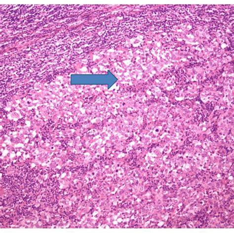 Pdf Case Report Intramammary Lymph Node Metastasis Of An Unknown Primary Probably Occult