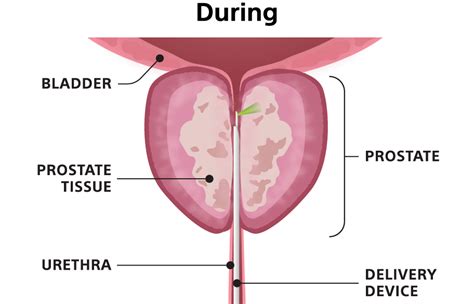 What Happens After Greenlight Laser Prostate Surgery