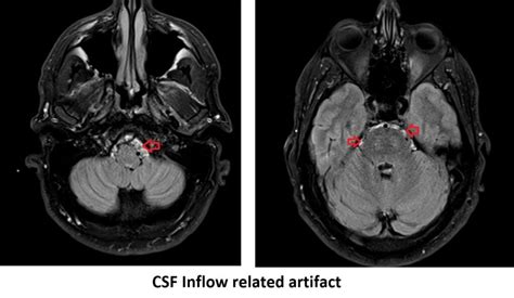 Motion Artifact Brain Mri At Jeremiah Jobe Blog