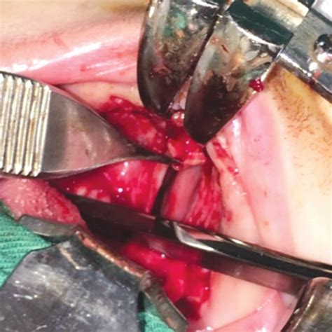 Showing Insetting Of The Anterior Triangular Flap Download