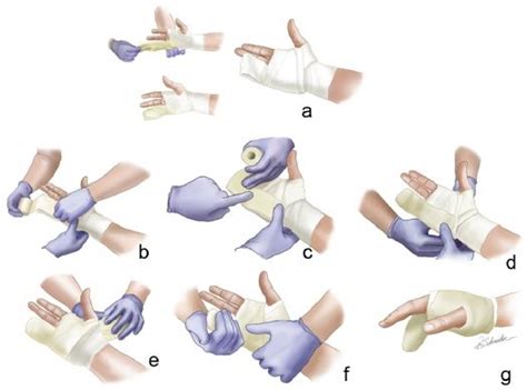 Short Ulnar Gutter Cast For Gameplay A With The Hand Held In The