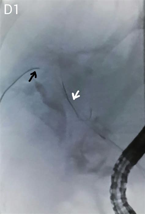 Ercp And Egd Major Biliary Tree Disruption Post Surgery