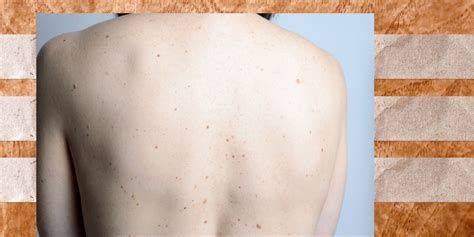 Mélanome Carcinomes Quest Ce Quun Cancer De La Peau Marie Claire