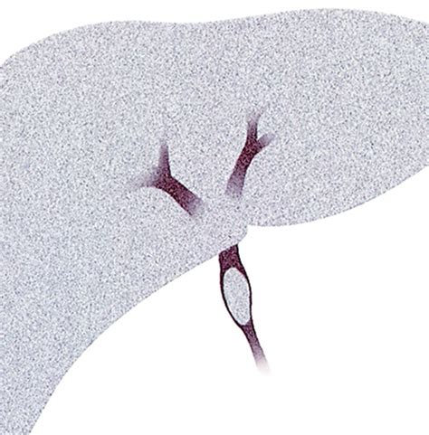 Ct And Mr Imaging Of Benign Hepatic And Biliary Tumors Radiographics