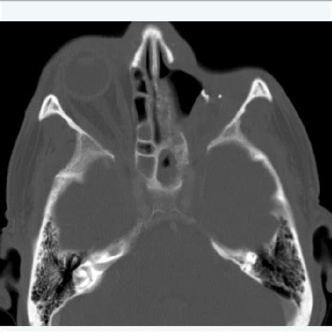 Computed Tomography Disclosing Sphenoid And Posterior Ethmoid Sinus