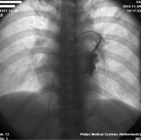 Venous Phase Of Selective Dpsa Download Scientific Diagram
