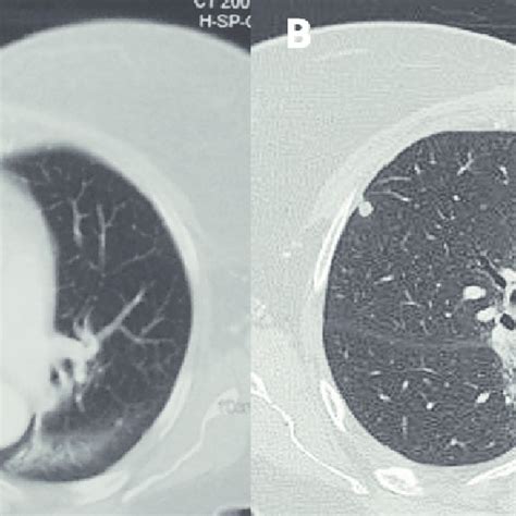 A Multiple Lung Metastasesmediastinal Nodal Diseasebilateral Pleural