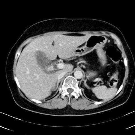 Gallbladder Cancer담낭암이 의심됩니다 네이버 블로그