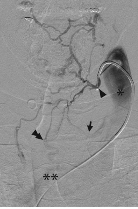 Thyroidal Venography During Parathyroid Hormone Venous Sampling The