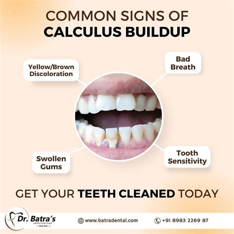Common Signs Of Calculus Buildup — Keeping Your Smile Healthy At Batra Dental Clinic By Dr