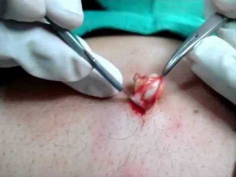 Complete Cyst Removal A Technique To Watch YouTube