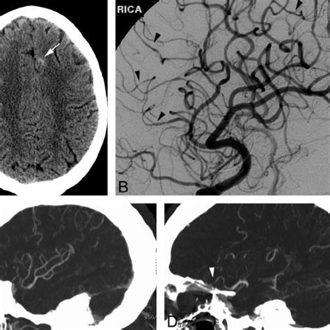 A Ncct Demonstrates Left Temporal Iph Asterisk And Tentorial Sdh
