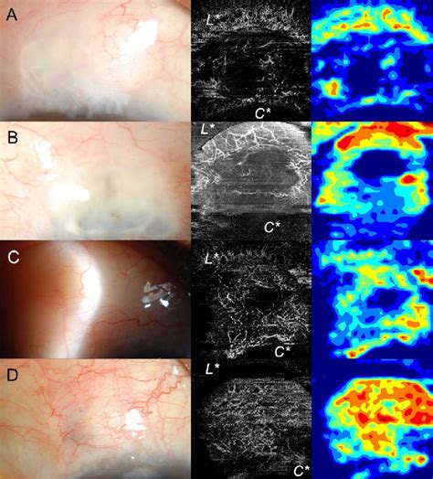 Figure 2 From Evaluation Of Functional Filtering Bleb Using Optical