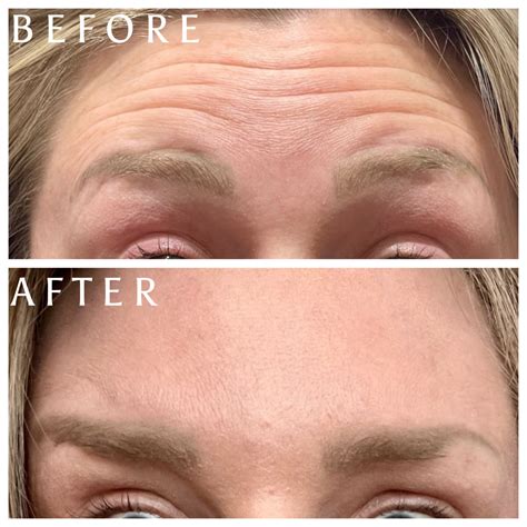 Botox Foxy Allure Aesthetics