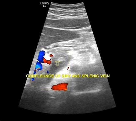 Superior Mesenteric Vein Ultrasound