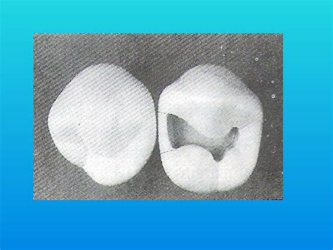 Class Ii Cavity Preparation For Amalgam Pptx Oral Care Personal Care