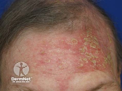 Sebopsoriasis