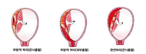 여성간호학 임신기 여성 고위험 임신 임신오조증유산습관성유산자궁외임신포상기태자궁경관무력증전치태반태반조기박리