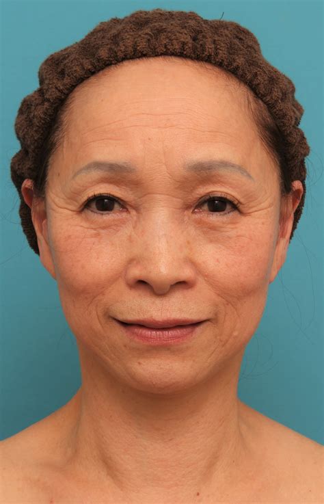 先日アップした、フェイスリフトで頬、フェイスライン、首のたるみをリフトアップさせた症例写真の解説 美容整形高須クリニック 高須 幹弥
