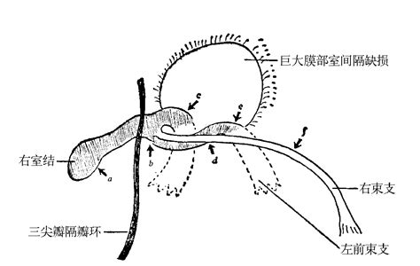 图24 17 巨大膜部室间隔缺损修补术中传导系的可能损伤部位 心脏外科基础图解 医学