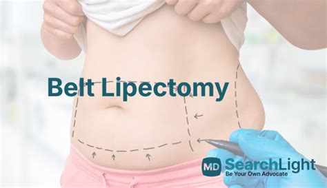 Belt Lipectomy Circumferential Body Lift Md Searchlight
