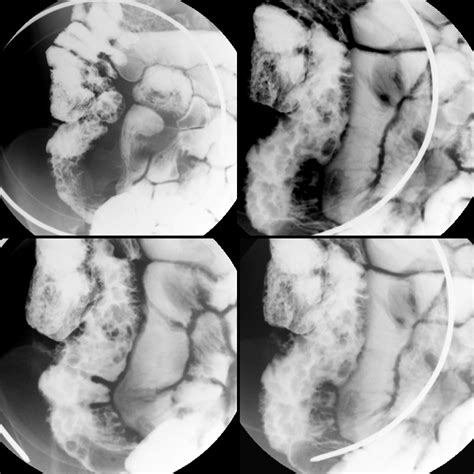 Gastrointestinal Nodular Lymphoid Hyperplasia Pacs