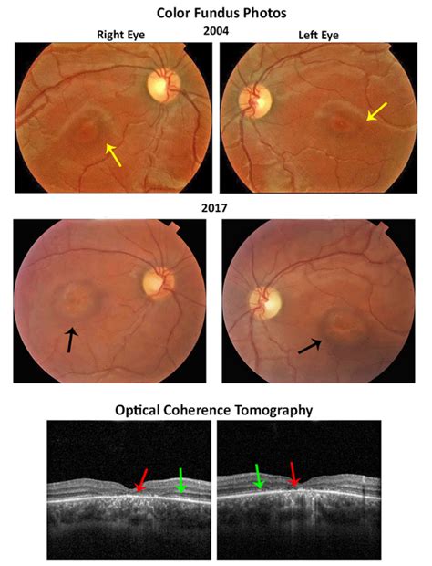 Cone Dystrophy Color Blindness At Zac Wilmot Blog